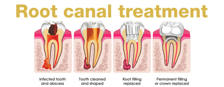 Root canal treatment – Pattaya International Dental center